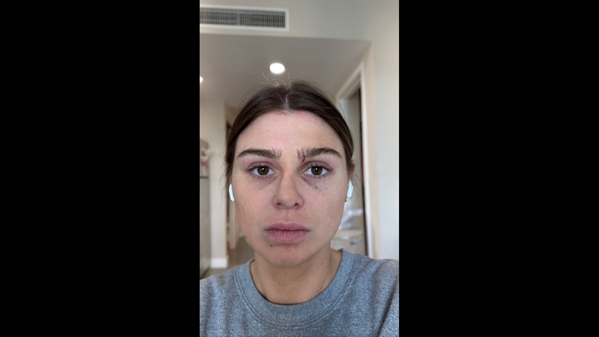 Raquel Leviss Alleges Scheana Shay Gave Her a Black Eye: PICS | kare11.com