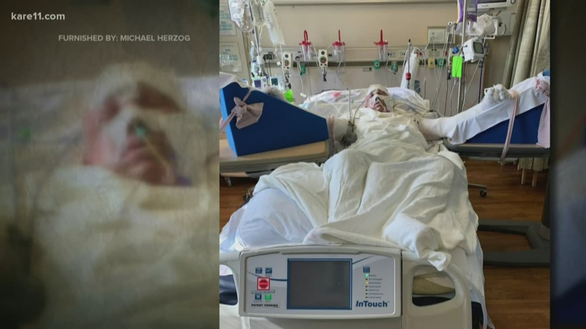 Burn victim discusses recovery | kare11.com