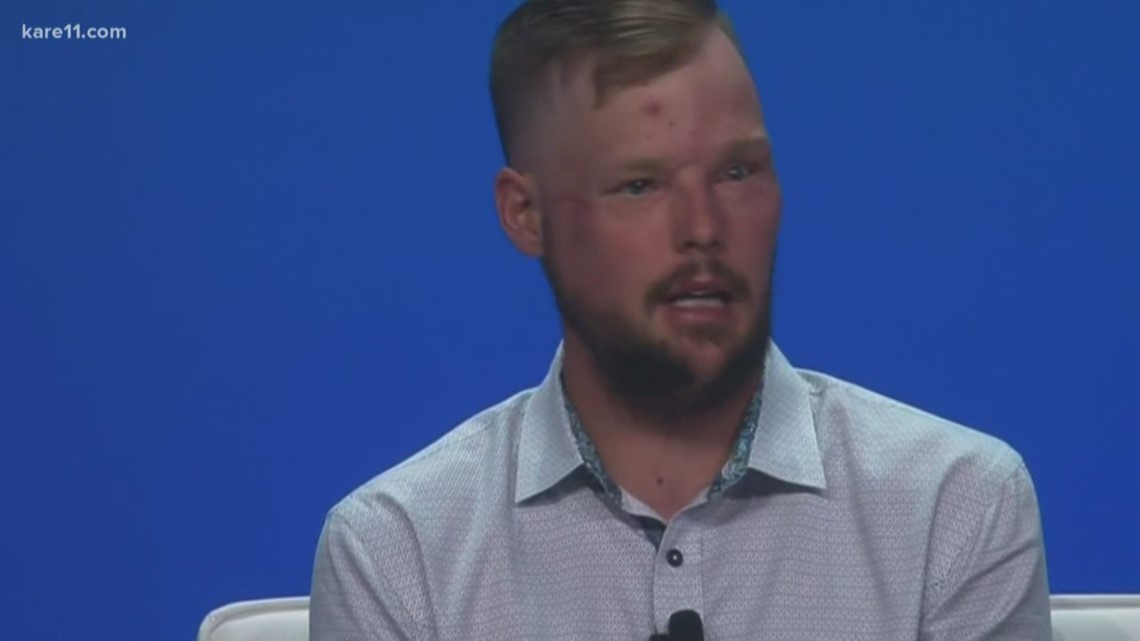 Mayo Clinic's first facial transplant recipient speaks about mental ...