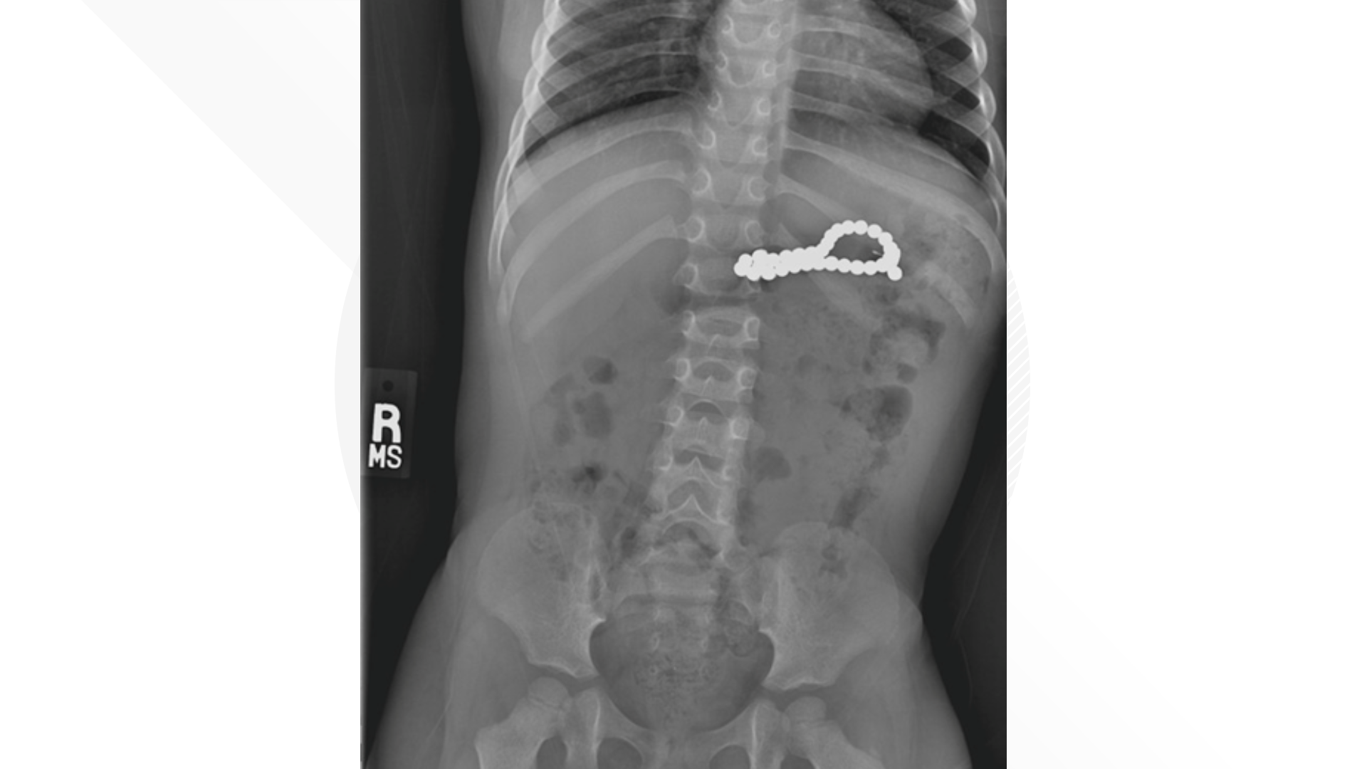 Minneapolis hospitals see uptick in children swallowing magnets ...