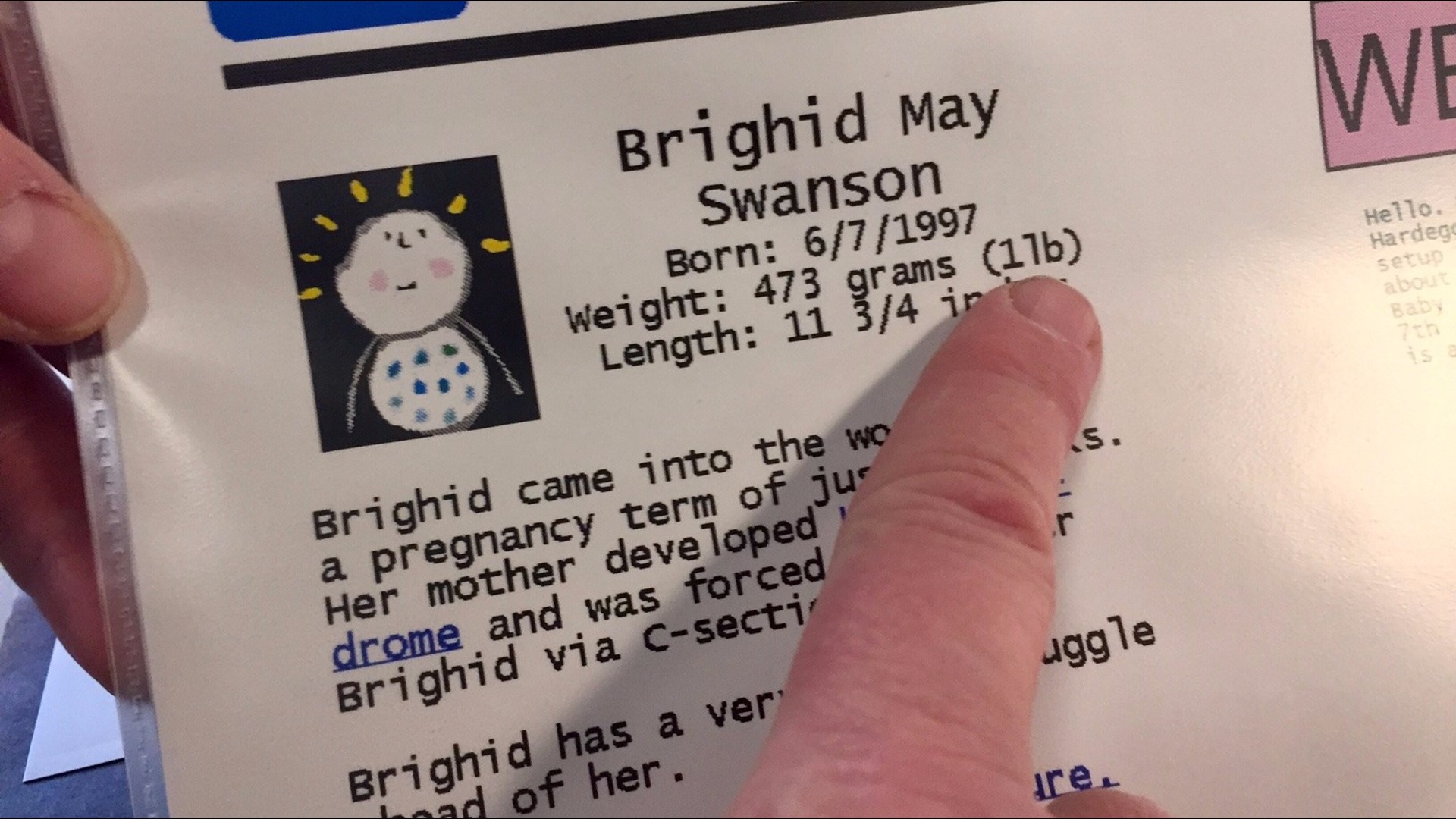 The preemie who launched CaringBridge | kare11.com