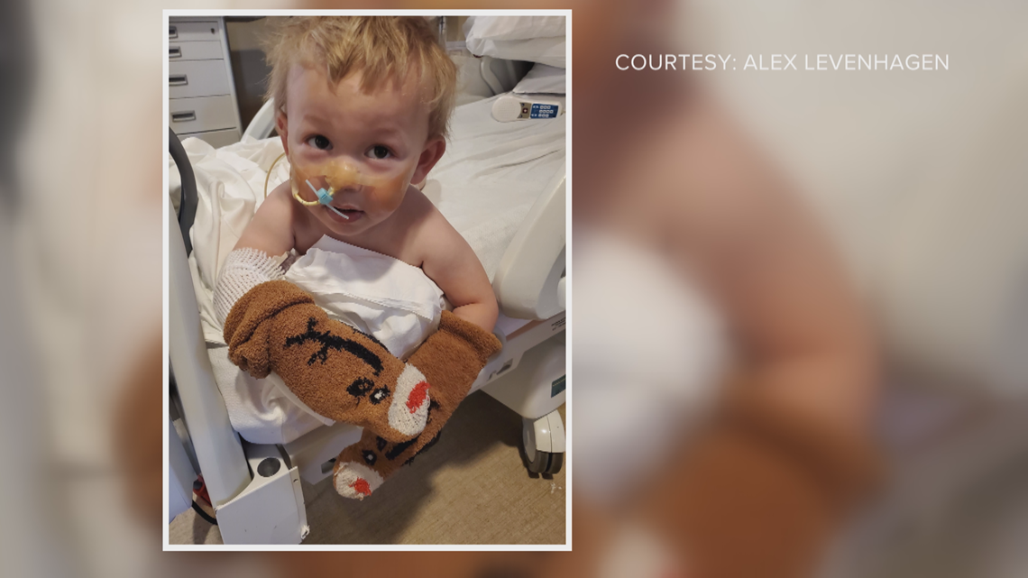 Family warns of fire pit danger after toddler gets third-degree burns ...
