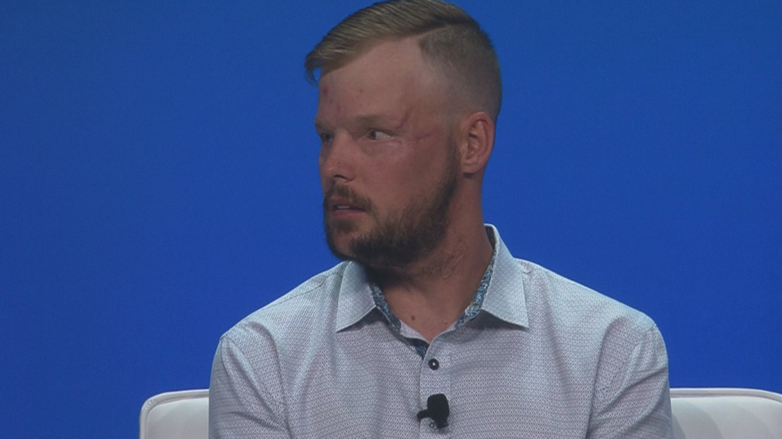 Mayo Clinic's first facial transplant recipient speaks about mental ...