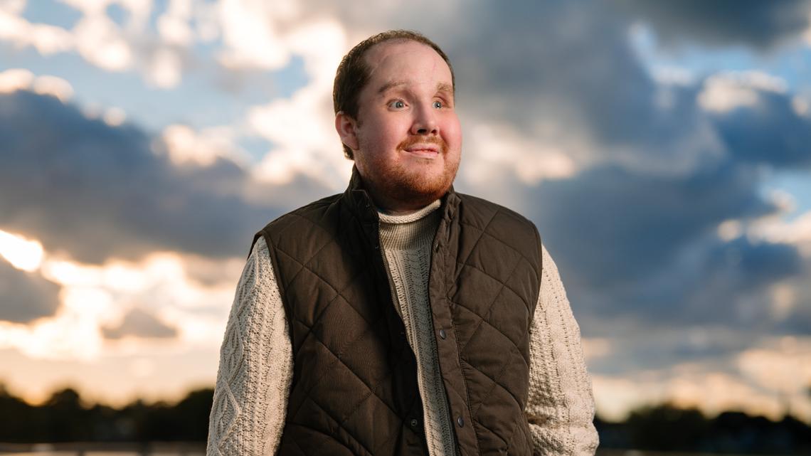 Michigan man gets successful face transplant at Mayo Clinic | kare11.com