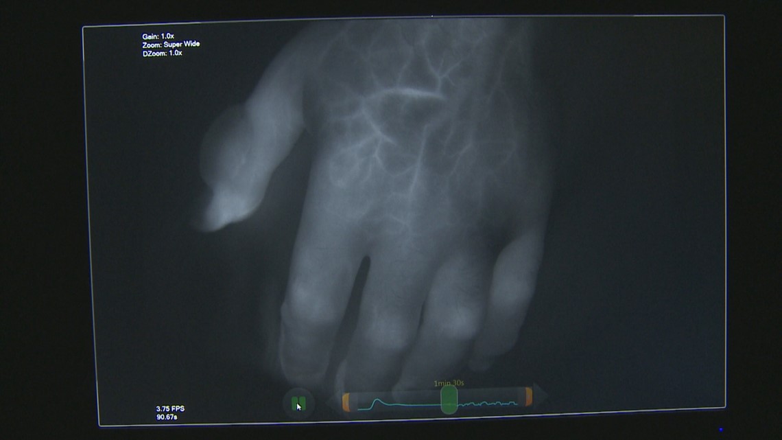 Doctors are seeing more frostbite cases this year due to extreme cold ...