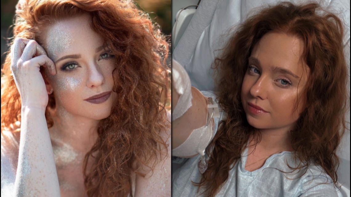 MN model shares struggle with bowel disease on social media, hoping to ...